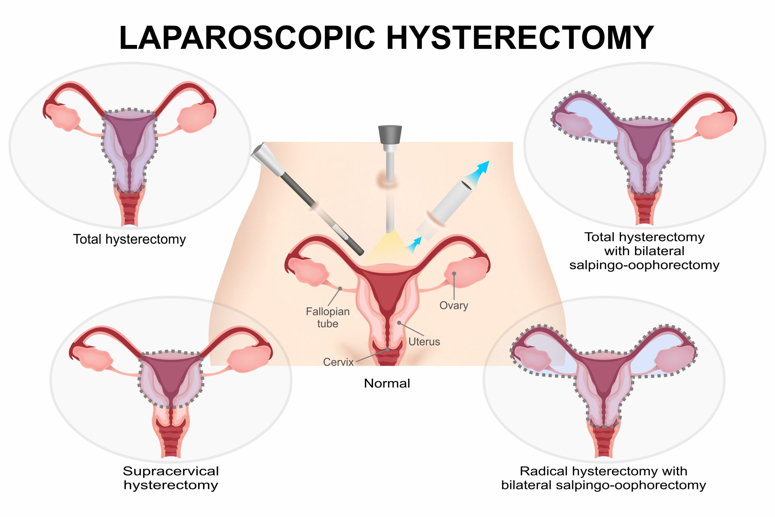 Partial Hysterectomy Hysterectomy: What It Is And What To Look Out For