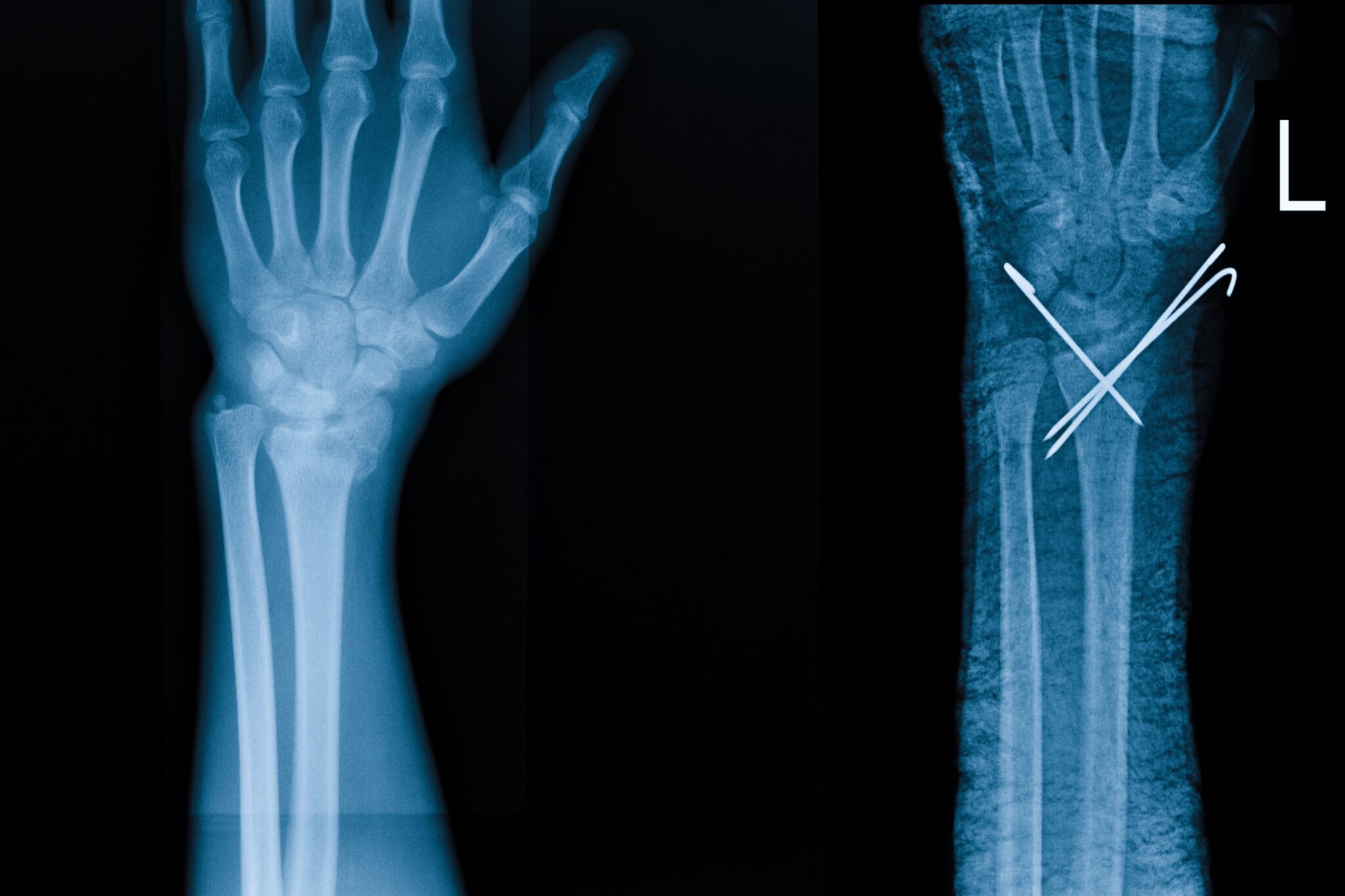 K-Wire Fixation - neo